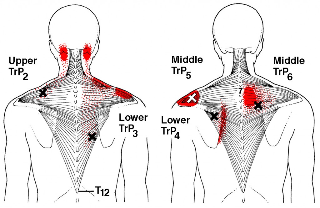 Burning Pain Between Your Spine And Shoulder Blade SIMPLE BACK PAIN